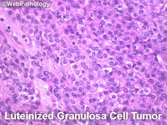 Steroid Cell Tumor, NOS : Differential