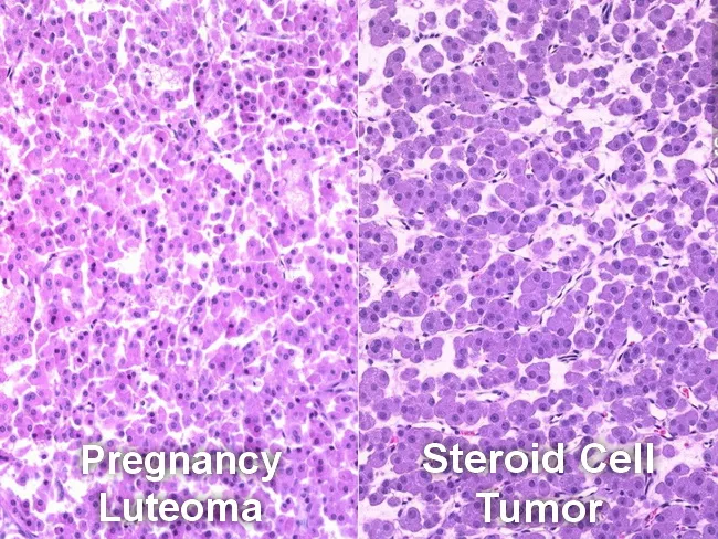 Steroid Cell Tumor, NOS : Differential