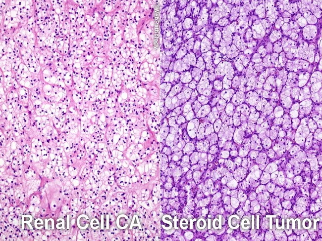 Steroid Cell Tumor, NOS : Differential