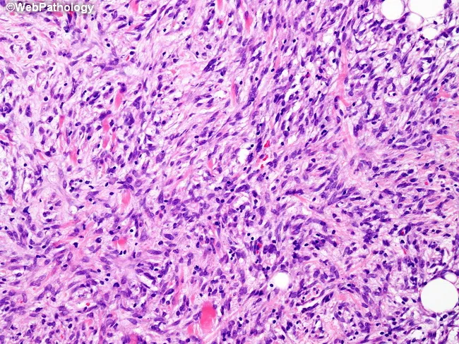 Spindle Cell Carcinoma : Fibrosarcoma-like
