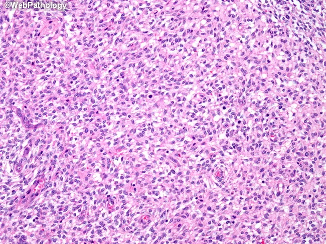 Metastatic Endometrial Stromal Sarcoma