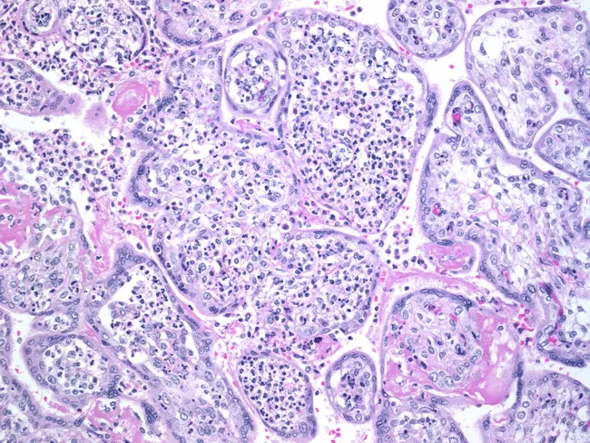 Acute Villitis