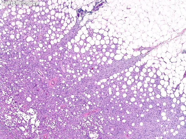 Spindle Cell Carcinoma : Fibrosarcoma-like