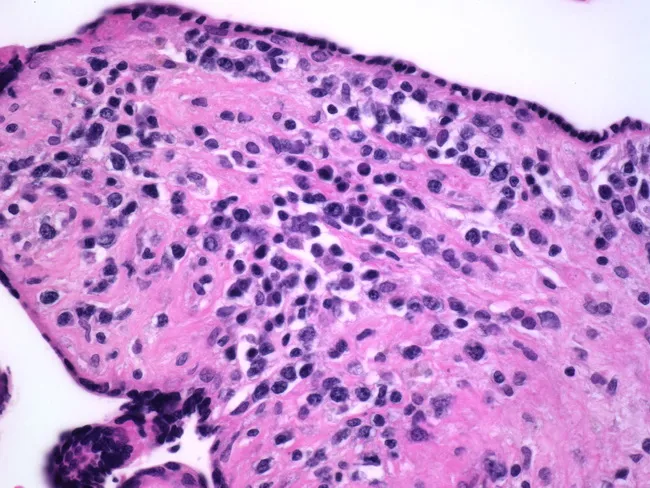 Chronic Villitis