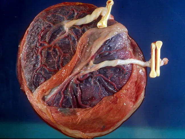 placenta duplex
