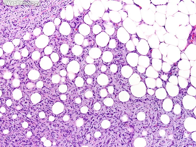 Spindle Cell Carcinoma : Fibrosarcoma-like