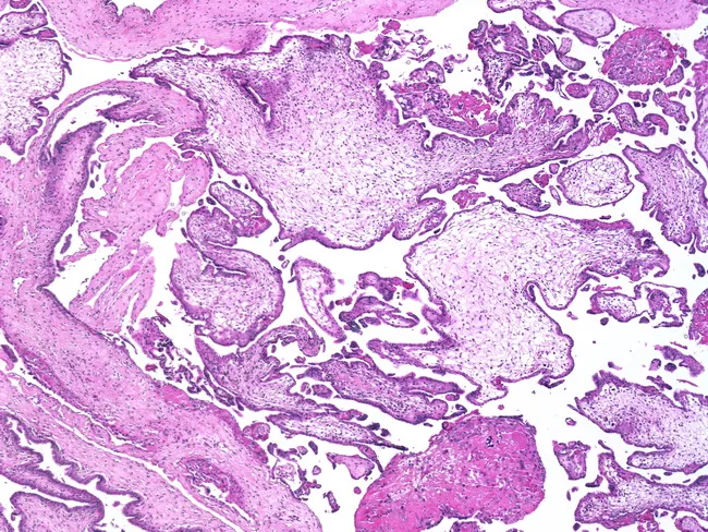 Partial Hydatidiform Mole