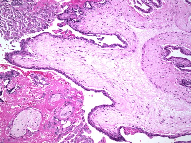 Partial Hydatidiform Mole