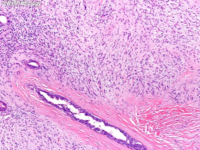 Spindle Cell Carcinoma : Fibrosarcoma-like