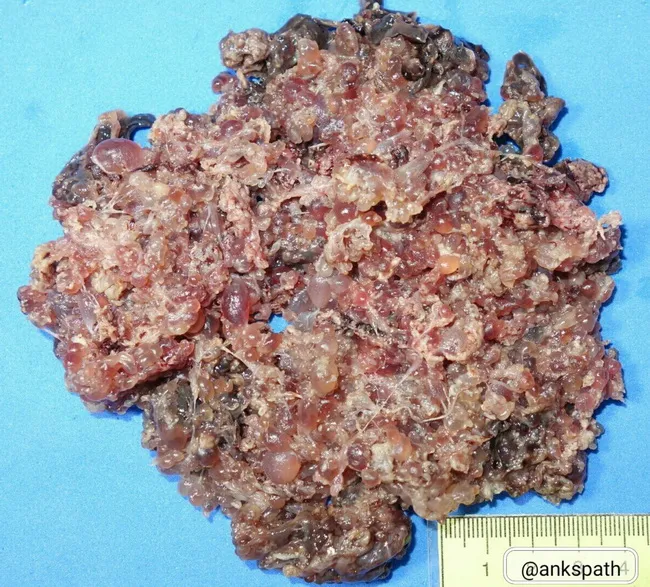 Complete Hydatidiform Mole