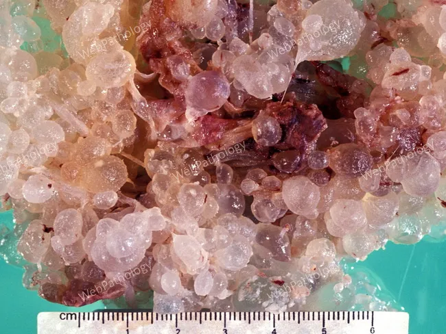 Complete Hydatidiform Mole