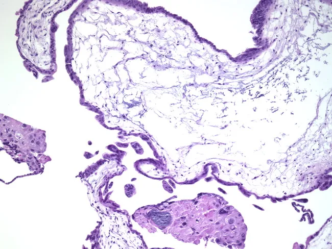 Complete Hydatidiform Mole