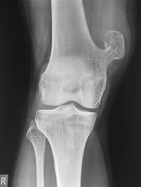 osteochondroma uk