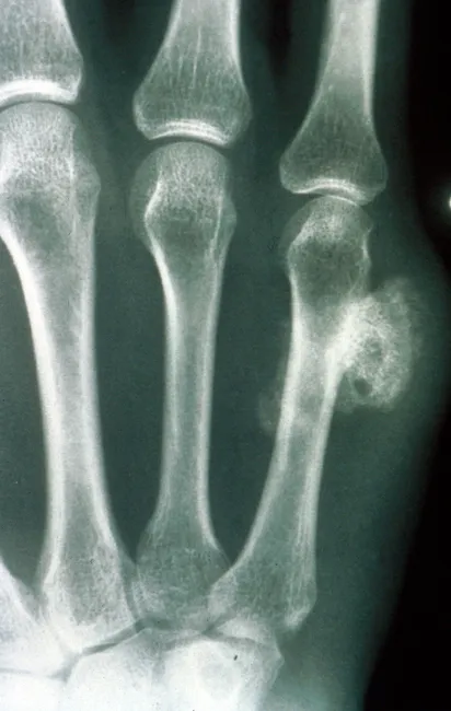 Bizarre Parosteal Osteochondromatous Proliferation (Nora's Lesion)