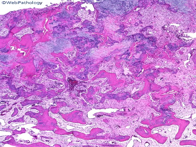 Bizarre Parosteal Osteochondromatous Proliferation (Nora's Lesion)