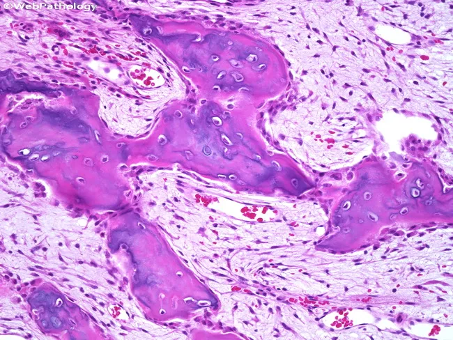Bizarre Parosteal Osteochondromatous Proliferation (Nora's Lesion)