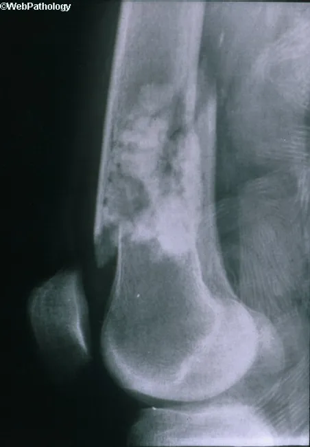 Chondrosarcoma : Femur