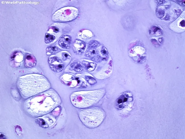 Chondrosarcoma Histology Drawing