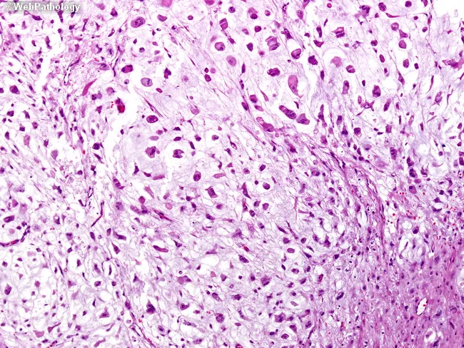 Chondrosarcoma, Grade III