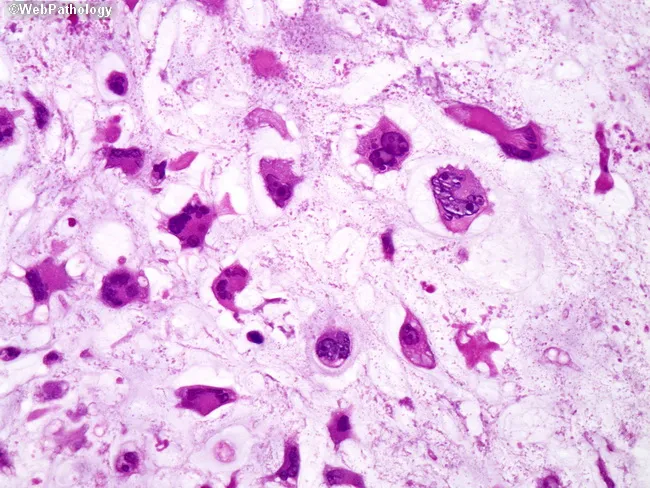 Chondrosarcoma, Grade III