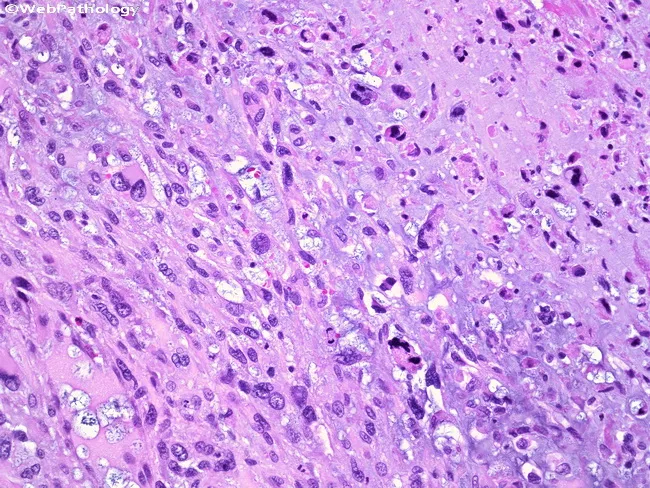 Chondrosarcoma : Grade III