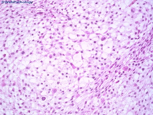 Chondrosarcoma : Myxoid stroma