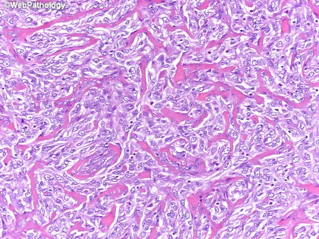 Spindle Cell Carcinoma : Fibromatosis-like
