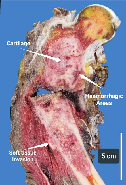osteosarcoma bone gross