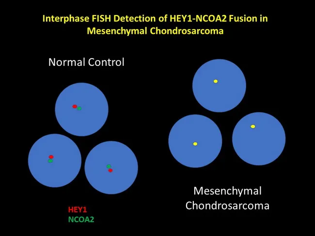 Mesenchymal Chondrosarcoma :HEY1-NCOA2Fusion