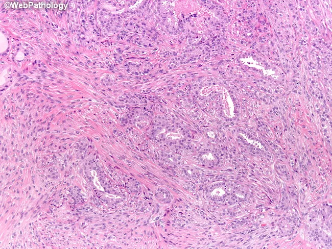Spindle Cell Carcinoma : Differential