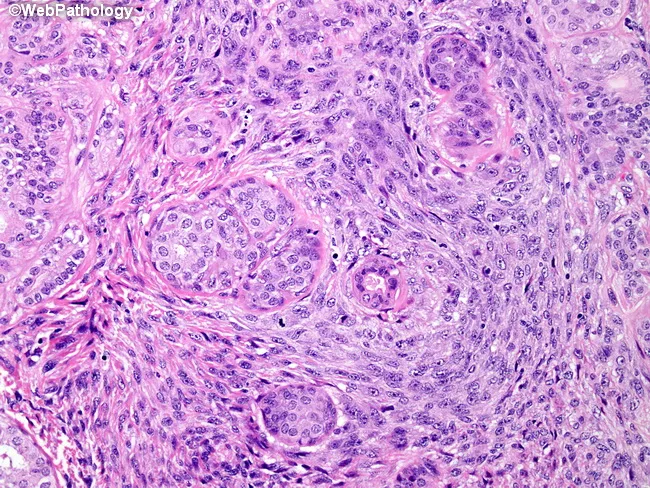 Spindle Cell Carcinoma