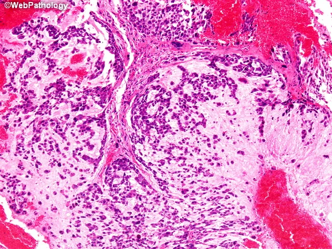 Matrix-producing Breast Carcinoma