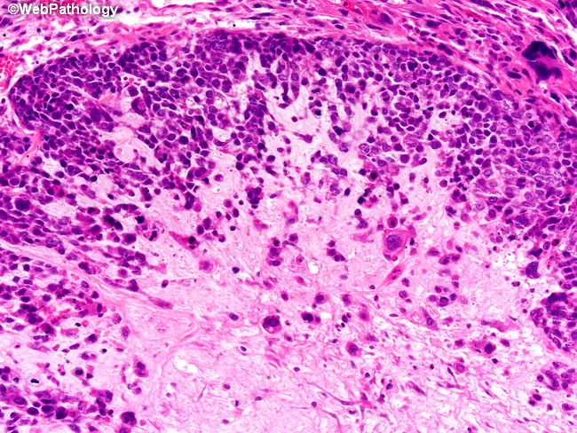 Matrix-producing Breast Carcinoma