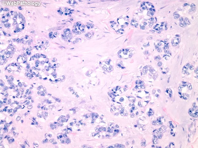 Matrix-producing Breast Carcinoma