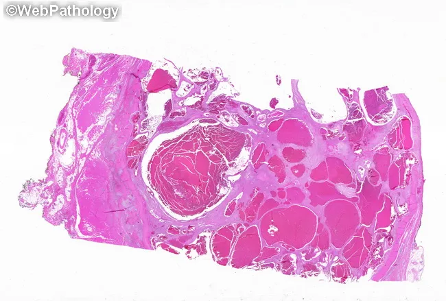 aneurysmal bone cyst ppt