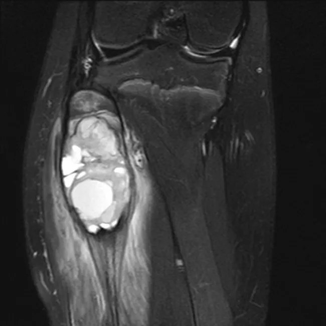 Aneurysmal Bone Cyst : Imaging - Case 1