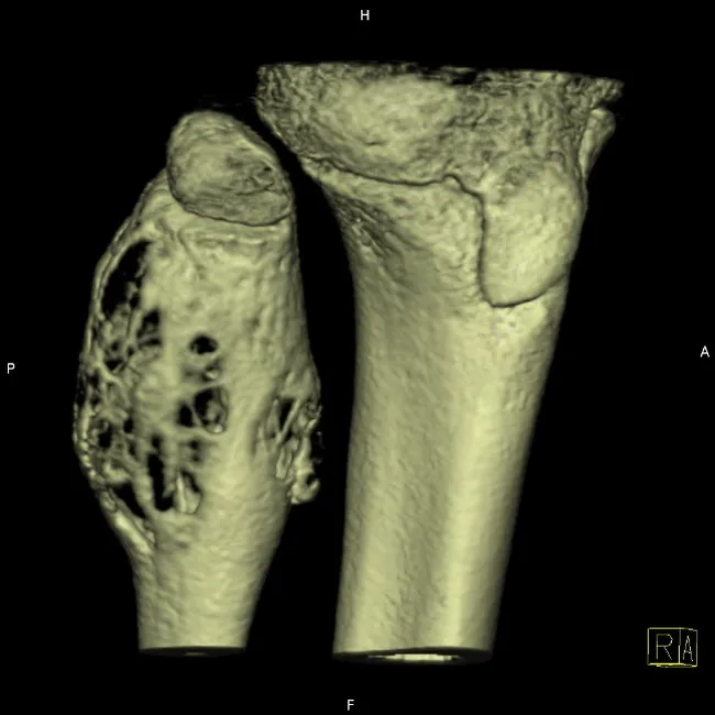 Aneurysmal Bone Cyst : Imaging - Case 1