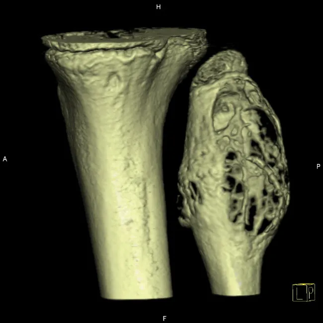 Aneurysmal Bone Cyst : Imaging - Case 1