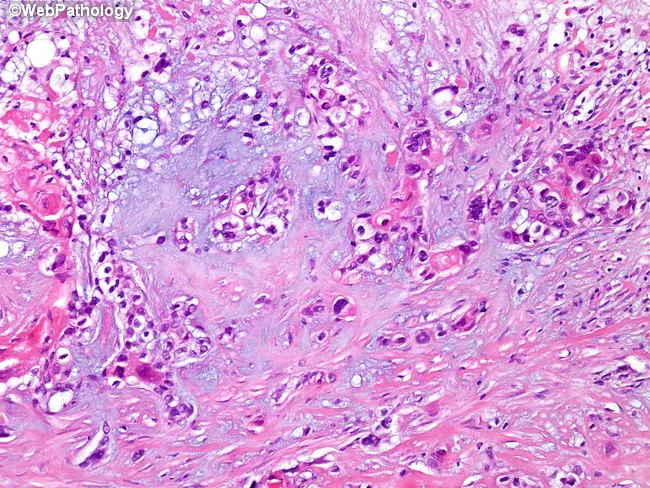 Matrix-producing Breast Carcinoma