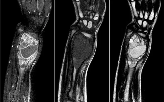 Aneurysmal Bone Cyst : Case 6