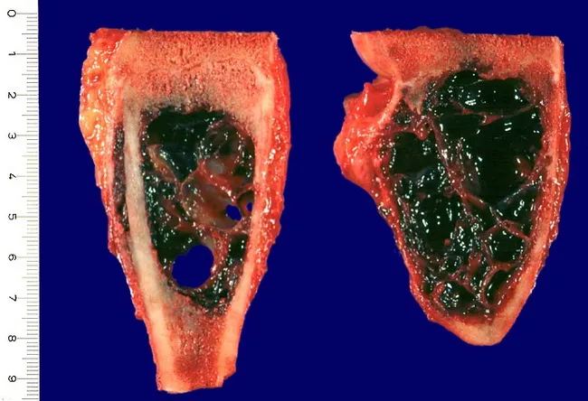 aneurysmal bone cyst