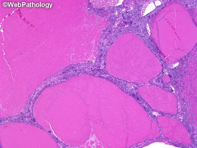 aneurysmal bone cyst ppt