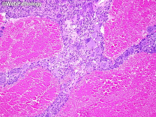 aneurysmal bone cyst ppt