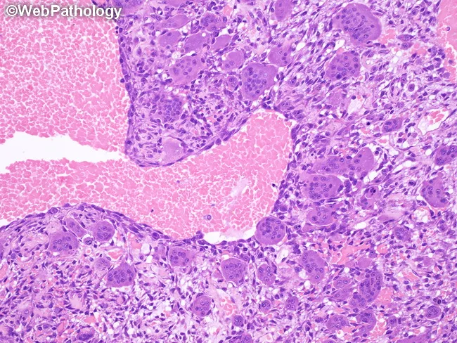 Aneurysmal Bone Cyst : Differential