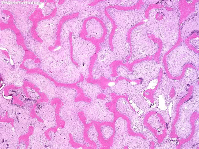 Fibrous Dysplasia : Microscopic