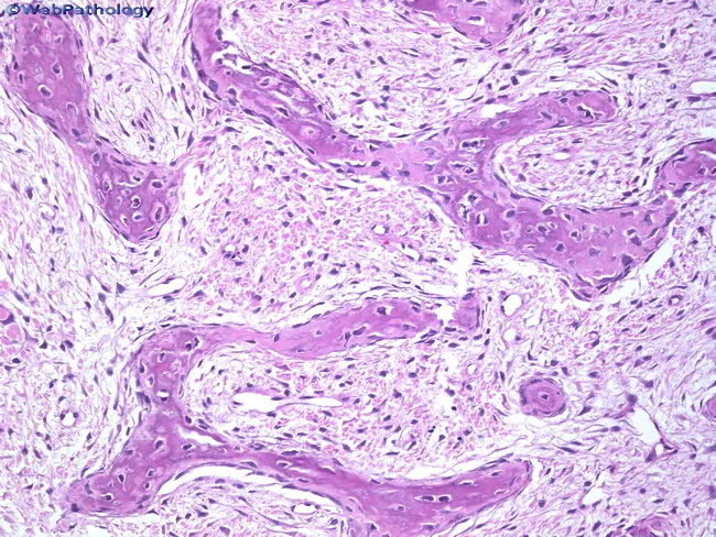 Fibrous Dysplasia : Microscopic