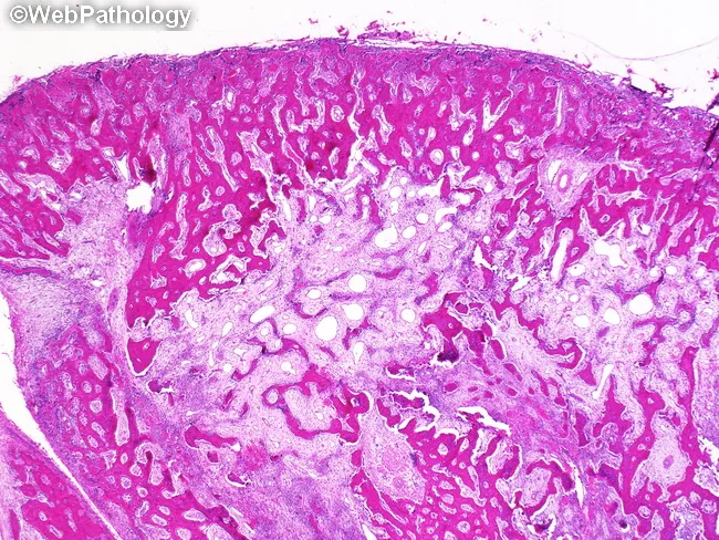 Myositis Ossificans : Pathogenesis