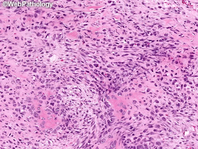 Myositis Ossificans - Differential