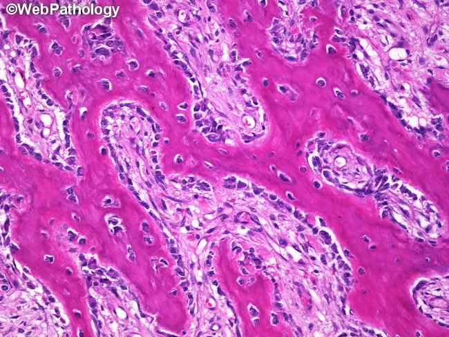 Myositis Ossificans - Differential
