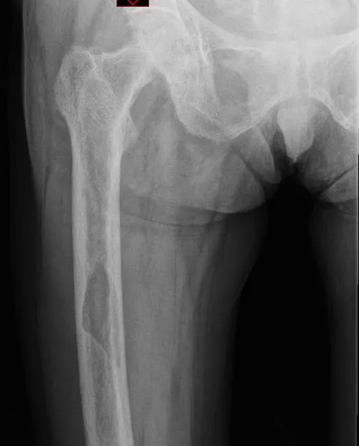 normal bone scan radiopaedia